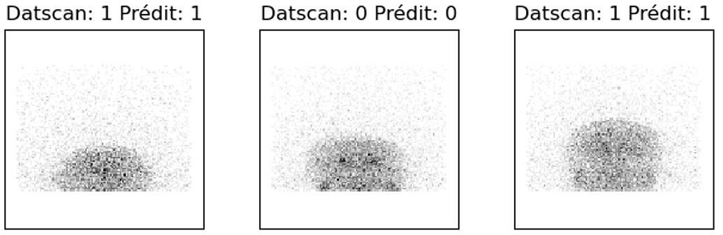 Medical binary classification with BCE Loss: threshold? - vision - PyTorch Forums